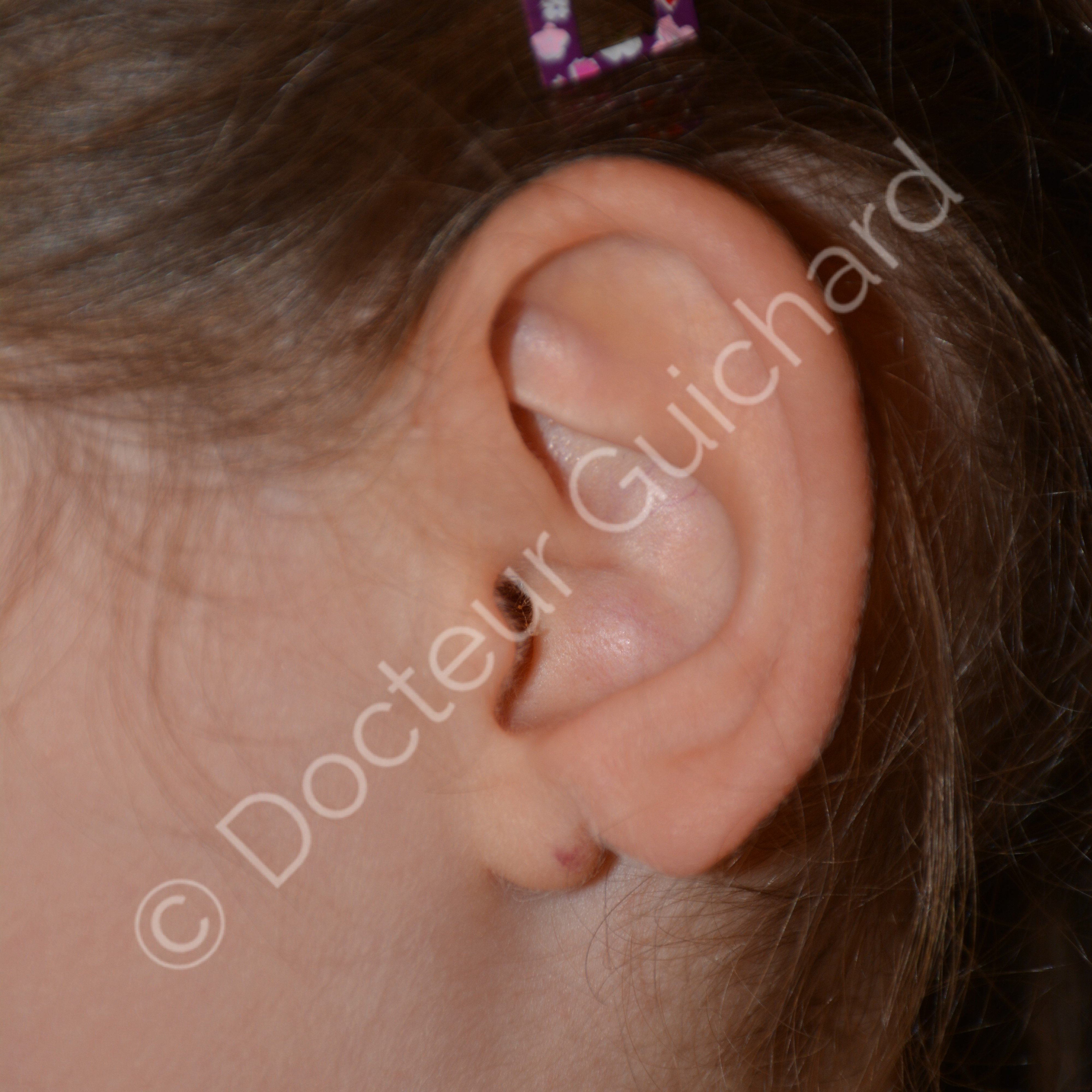 PETITES ANOMALIES: LE LOBULE - Dr Stéphane Guichard - Service de ...