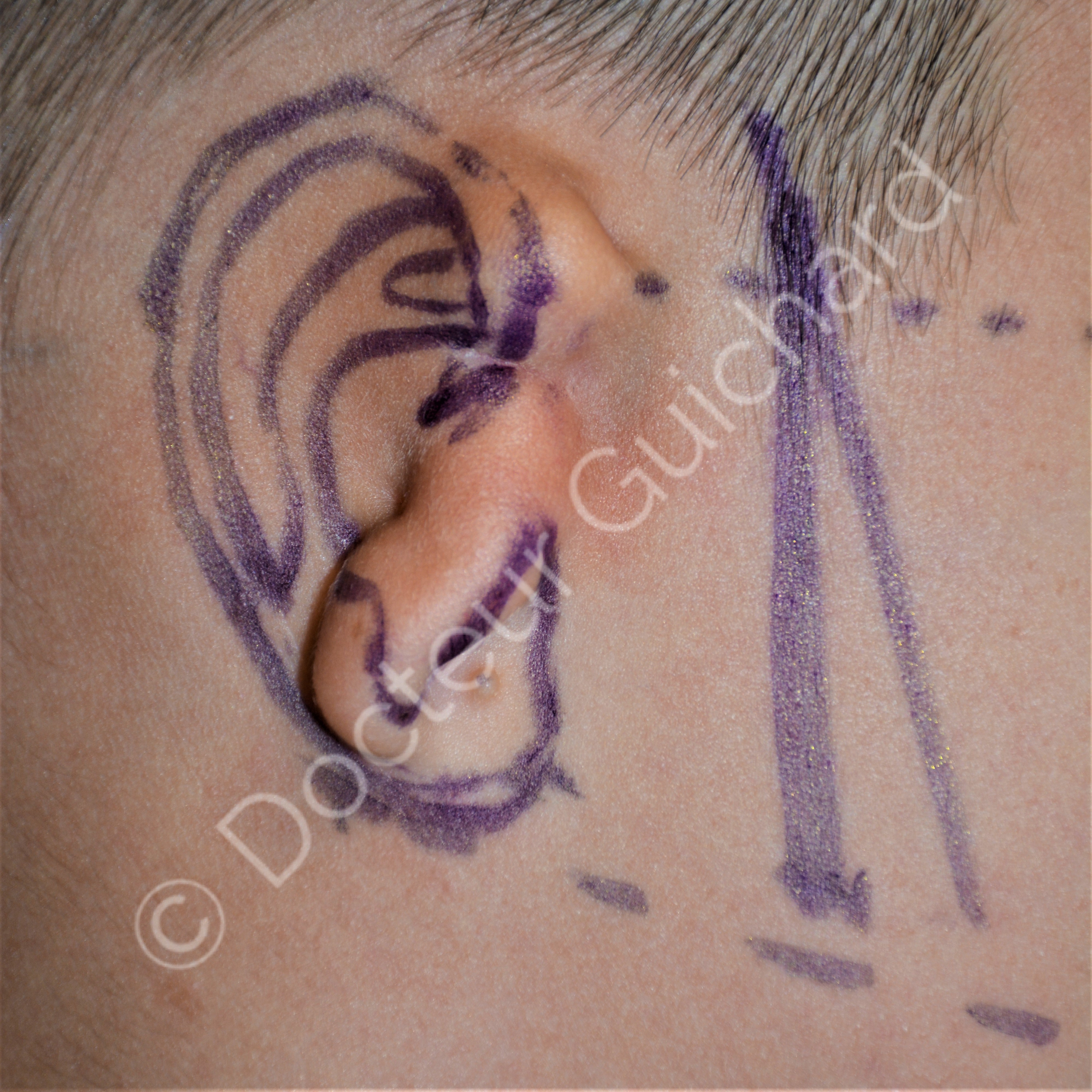 1° temps de reconstruction: le cartilage - Dr Stéphane Guichard ...