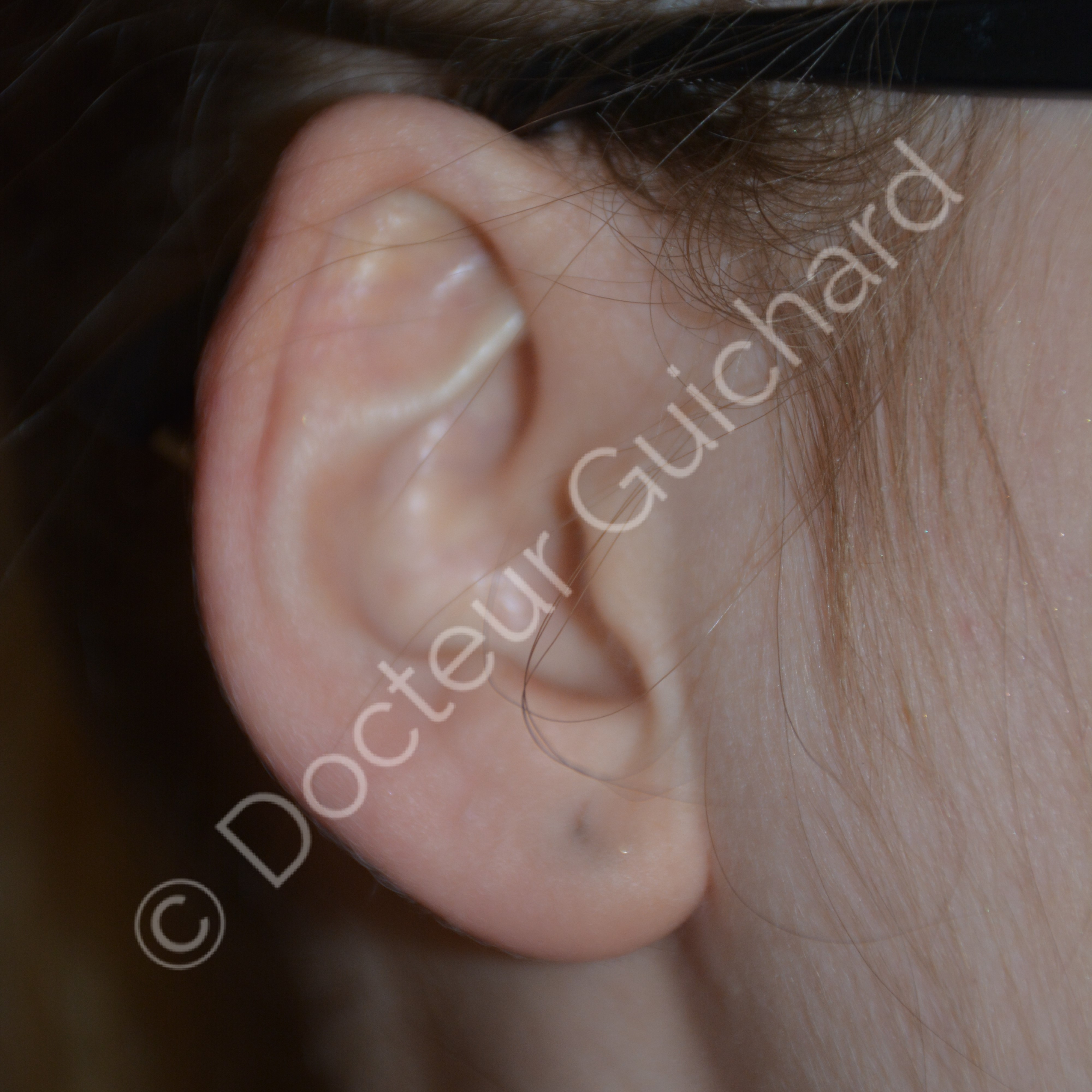 PETITES ANOMALIES: L'HELIX - Dr Stéphane Guichard - Service de ...